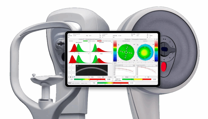 Ectasia Screening - Early Detection & Analysis - OCULUS Germany